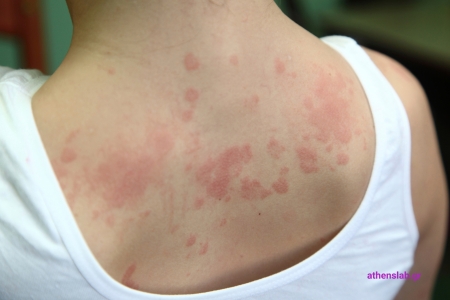 what is dermatitis herpetiformis caused by